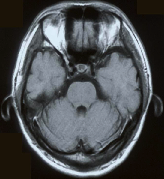 【実習】脳のMRI断面図！実際の画像を見て理解をしよう！