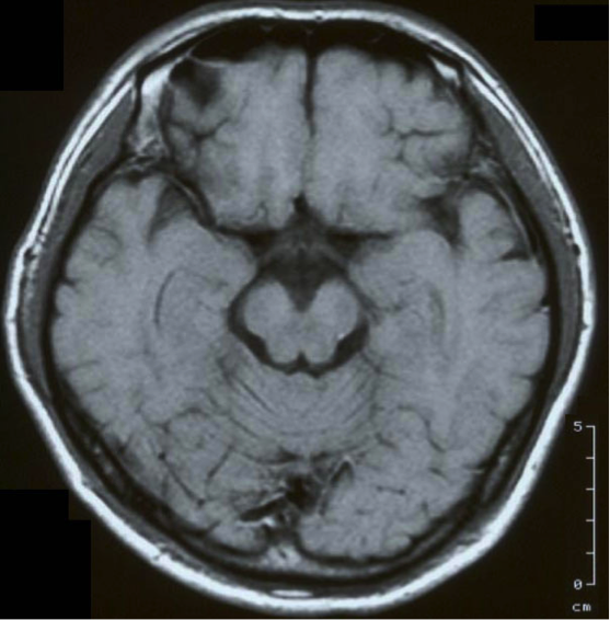【実習】脳のMRI断面図！実際の画像を見て理解をしよう！