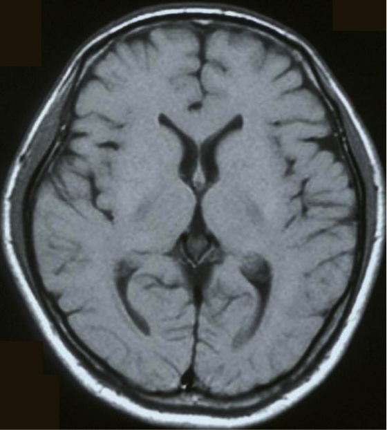 【実習】脳のMRI断面図！実際の画像を見て理解をしよう！