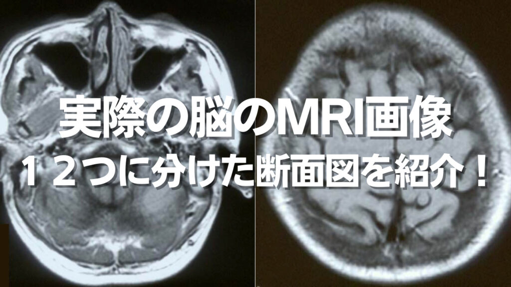 【実習】脳のMRI断面図！実際の画像を見て理解をしよう！